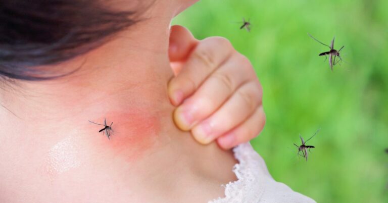 Bruise after insect bite: cause and what to do - Be Strong be Healthy